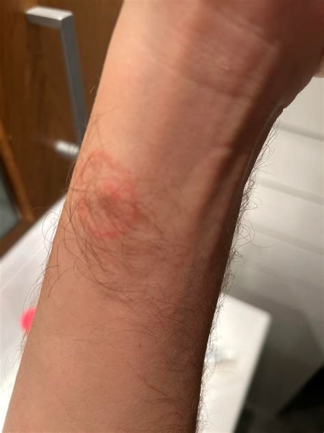 Is This A Tic Bite Or Ringworm R Ukhiking