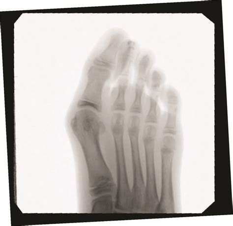 Metatarsus Primus Varus