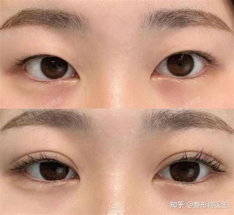 双眼皮开扇和平扇怎么选 知乎