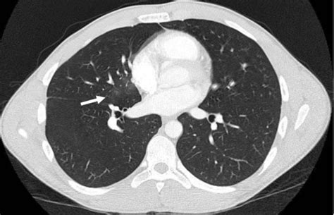 Contusion Pulmonar Pulmonary Contusion Pacs