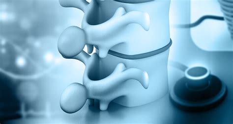 Nexus Spine Launches Stable C Cervical Interbody System BONEZONE