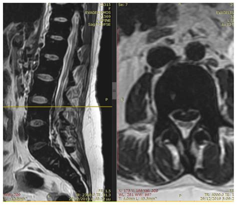 Unveiling Extramedullary Hematopoiesis A Case Report Highlighting The