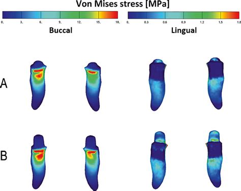 The Von Mises Stress Distribution In Canines Ball Attachments Model