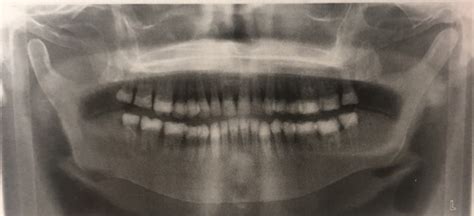Panoramic Errors Flashcards Quizlet