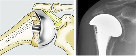 Shoulder Arthritis Cuff Tear Arthropathy Arthroplasty Uw Orthopaedic