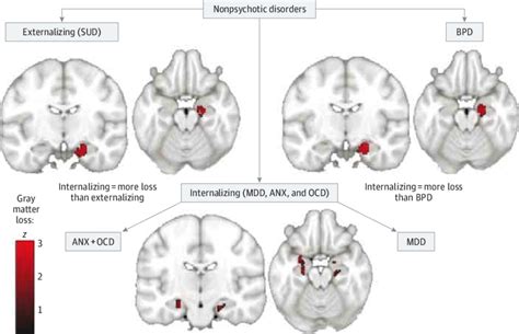 Voxel Based Morphometry Meta Analysis Contrasts Between Subdivisions Of
