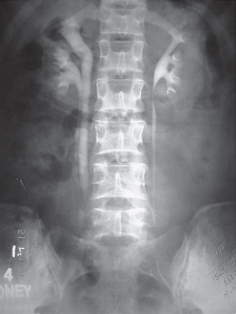 Figure 1 From Retroperitoneal Laparoscopic Uretero Pyelostomy For