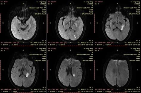 影像识别：前循环穿支动脉脑梗死 丁香园