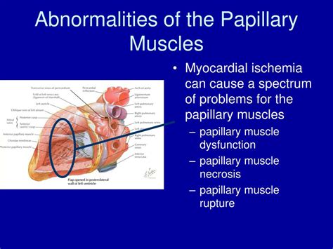 Ppt Mitral Regurgitation Powerpoint Presentation Free Download Id