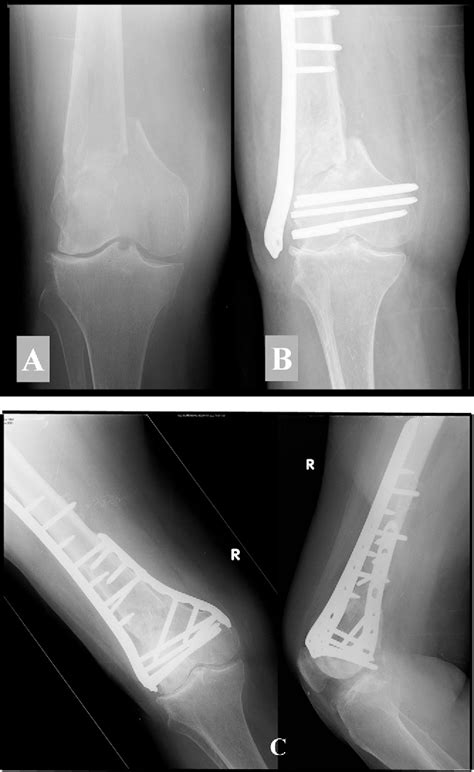 Distal Femur Fracture