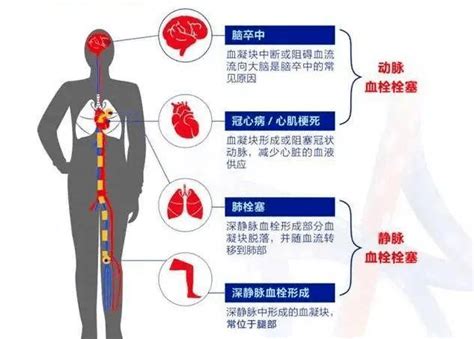 病情隐匿却能导致猝死儿童发病率被低估 血栓 治疗 疾病