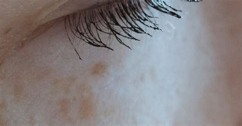 4 кроки для усунення темних плям на шкірі