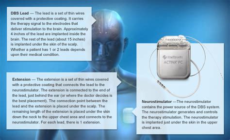 Curing Depression And Super Charging Cranial Capacity With Deep Brain Stimulation ExtremeTech
