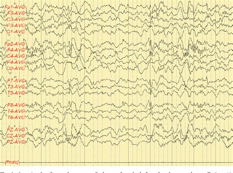 Figure 2 From A Characteristic Eeg Pattern Of Angelman Syndrome