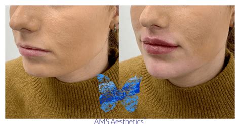 Cupids Bow Lip Everything You Need To Know Ams Aesthetics