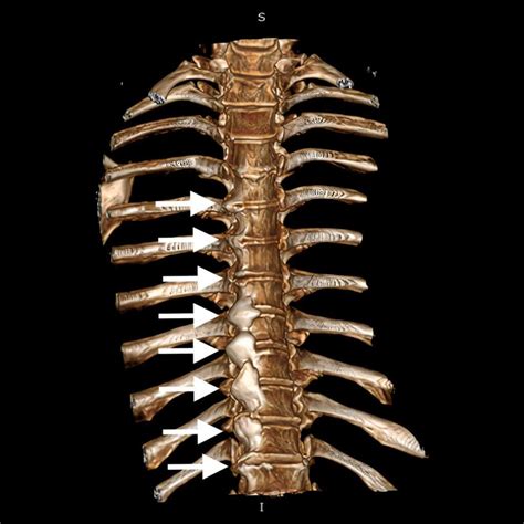 A Closer Look At Dish Idiopathic Skeletal Hyperostosis Explained
