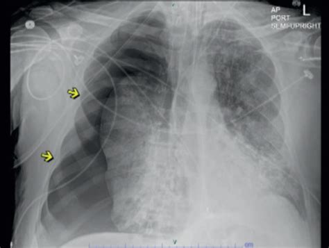 A Cxr Showing A Large Right Sided Pneumothorax B Cxr Showing Download Scientific Diagram