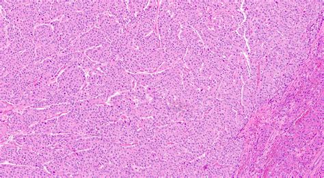 Pathology Outlines Acinar Cell Carcinoma