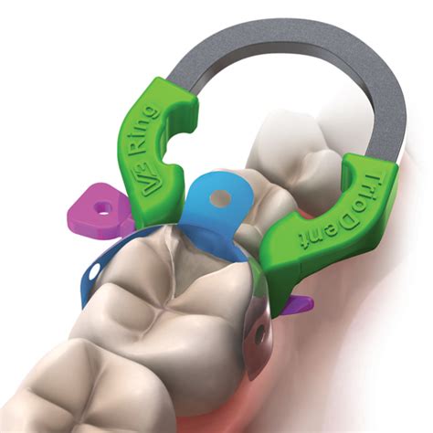 Versatile V3 Sectional Matrix System Streamlines Class Ii Composite Restorations Compendium