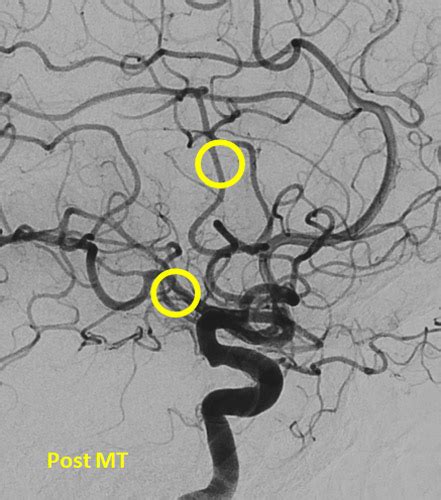 Solitaire 3x20 And 6x40 In Simultaneous 2 Branch Occlusions With Tici 2c Reperfusion In First Pass Solitaire 3x20 And 6x40 In Simultaneous 2 Branch Occlusions With Tici 2c Reperfusion In First Pass