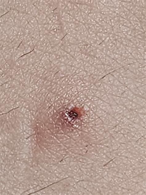 점은 아닌데 피부 안에 있는 검은 색 무언가 지식in