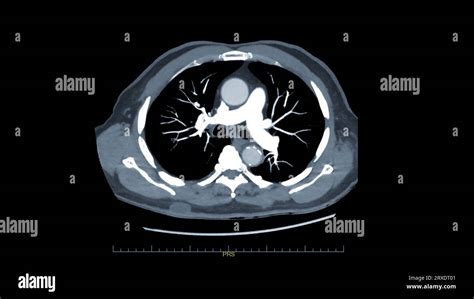 Ctpa Or Cta Pulmonary Artery For Diagnostic Pulmonary Embolism Pe