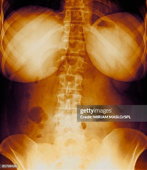 Normal Chest X Ray Labeled