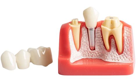 Crown Vs Root Canal Which Is Right For You