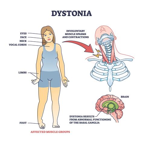 Acute Dystonia