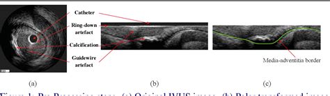Figure 1 From Graph Based Segmentation Of Optimal Ivus Media Adventitia