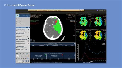 Philips Intellispace Portal Clinical Application Ct Brain Perfusion Youtube