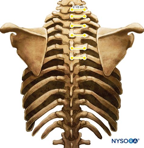 Thoracic And Lumbar Paravertebral Block Landmarks And Nerve Stimulator Technique Nysora
