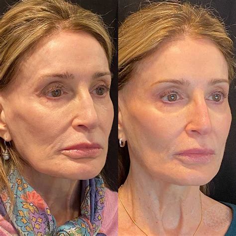 Sculptra The Top Choice For Non Surgical Cheek Lift Hush La Medspa