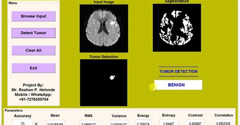 Matlab Code For Brain Tumor Detection And Classification Using Image Processing Ieee Project