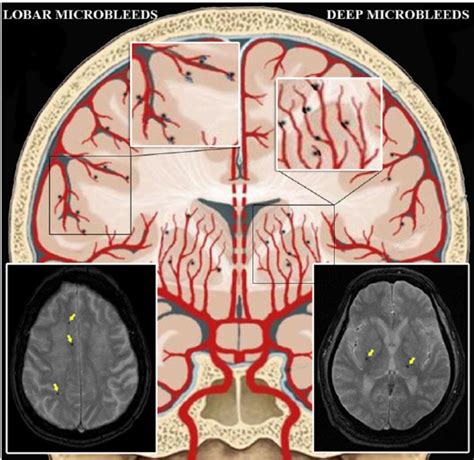 The Topography Of Cerebral Microbleeds And Their Magnetic Resonance Download Scientific Diagram