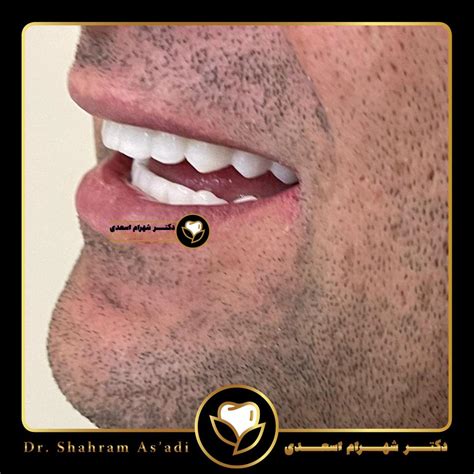 کشیدن دندان و کاشت ایمپلنت همزمان ایمپلنت فوری ایمپلنت دندان دکتر شهرام اسعدی