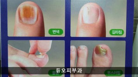 [성신여대피부과] 발톱무좀레이저치료 가족들에게 전염되기 전에 서둘러야 네이버 블로그