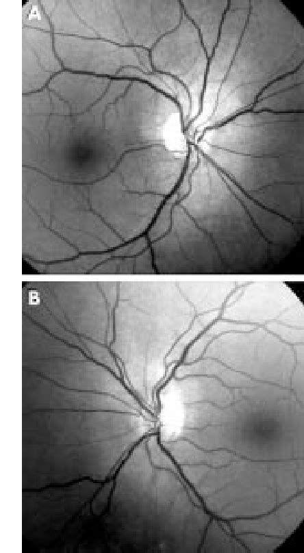 Figure 2 From Retinal Arteriolar Calcification In A Patient With