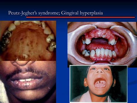 Ppt Pathology Of The Oral Cavity Powerpoint Presentation Free