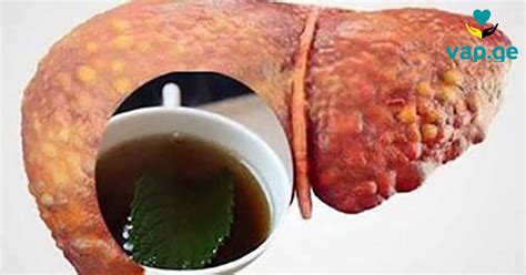 სასმელი რომელიც საოცრად წმენდს ღვიძლს და ეფექტურად წვავს მუცლის ცხიმსაც Vap Ge