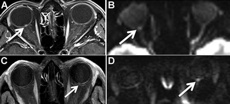 Diffusion Weighted Imaging And Post Contrast Enhancement In