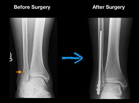 Fibula Fractures Robert Sheinberg Dpm Weston Fl Podiatrist