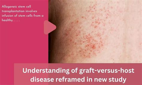 Understanding Of Graft Versus Host Disease Reframed In New Study