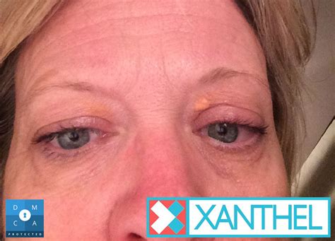 Xanthelasma Photo Gallery Pictures By Xanthel®
