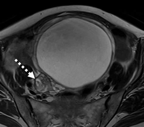 Adnexal Torsion Review Of Radiologic Appearances Radiographics