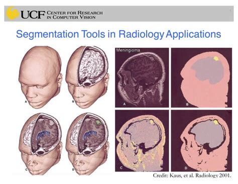 Lec Medical Image Segmentation I Radiology Applications Of Segmentation And Thresholding