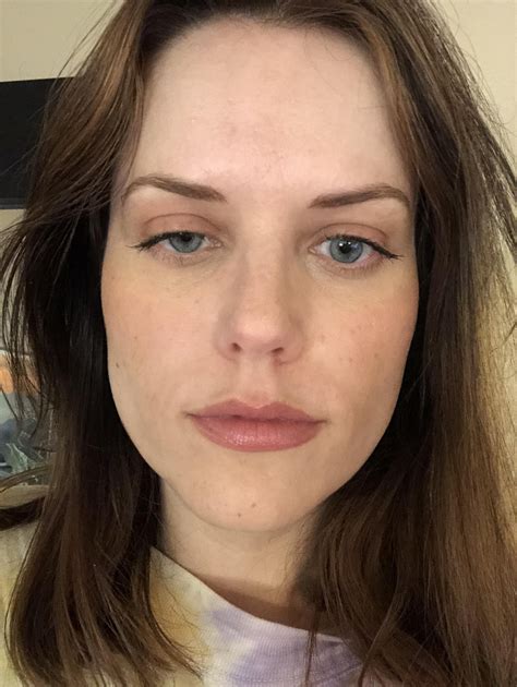 Internal Ptosis Repair Dr Ray Taban Beverly Hills Ca 3 Weeks Post