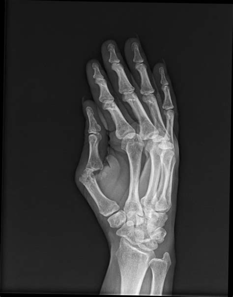 Metacarpophalangeal Joint Dislocation