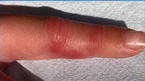 Chilblains What You Need To Know Symptoms Pictures