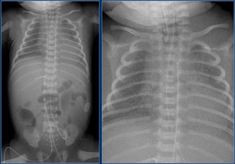 Picc Line X Ray Neonate